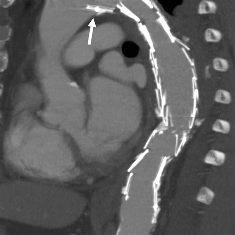 Endoleak Free Survival For Type I Or Type Iii Endoleaks For Thoracic