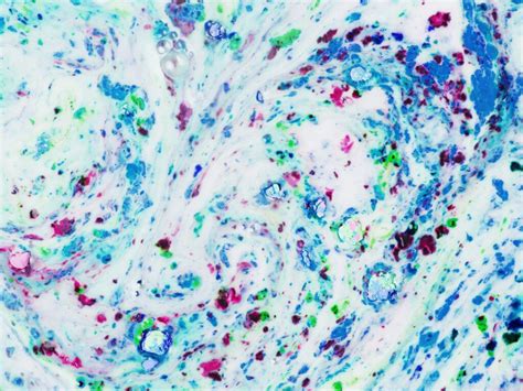 Inherited Bone Marrow Failure Syndromes Ibmfs Classical Hematology