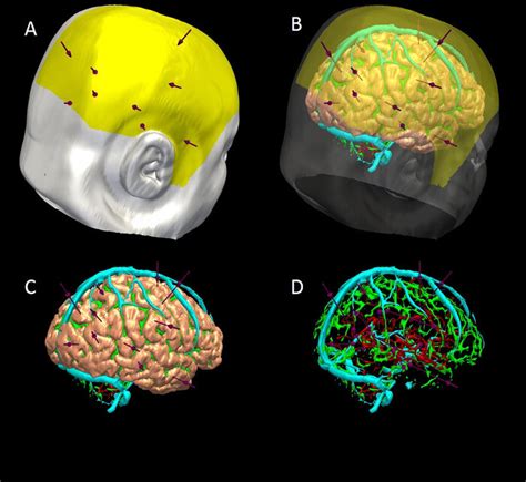 3d Multimodality Models Of Computer Assisted Trajectory Planning A Download Scientific