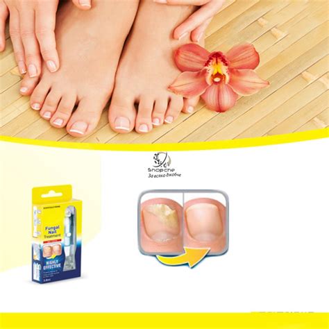 СИСТЕМА ЗА ПРЕМАХВАНЕ НА ГЪБИЧКИ ПО НОКТИТЕ Shopche за вашето джобче