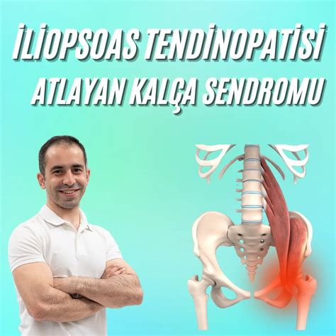 İliopsoas Tendinopatisi Tendinit Snapping Hip M Terapi