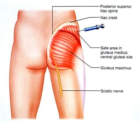 How To Do Ventrogluteal Injection Glute Injection Guide And Demo