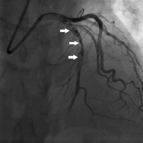 Lad Injection Shows Occlusion Of Proximal Part By Fresh Thrombus Download Scientific Diagram