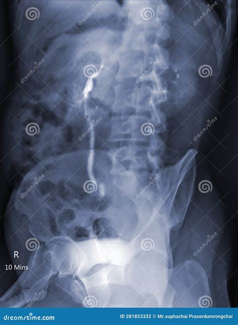 Intravenous Pyelogram Or I V P Stock Photo Image Of Adrenal Renal