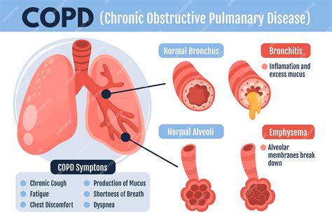 Free Vector Flat Hand Drawn Copd Infographic Template