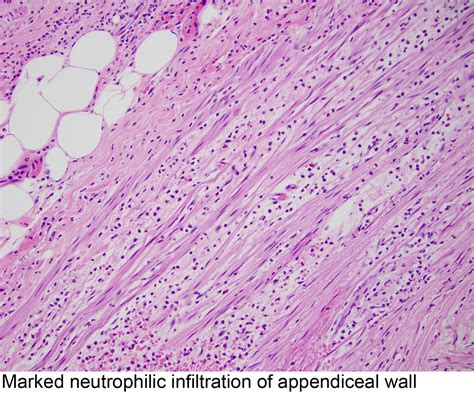 Pathology Outlines Acute Appendicitis