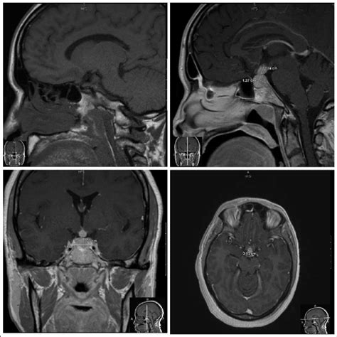 Initial Magnetic Resonance Imaging Findings Total Measurement Was 21
