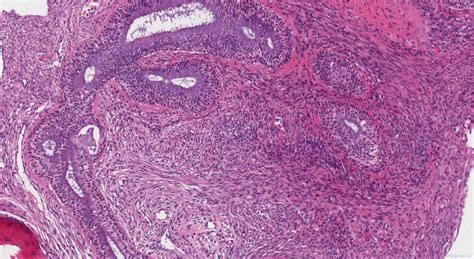 Biphenotypic Sinonasal Sarcoma Ottawa Atlas Of Pathology