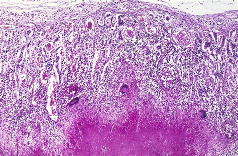 Miliary Tuberculosis Light Micrograph Stock Image C001 8826