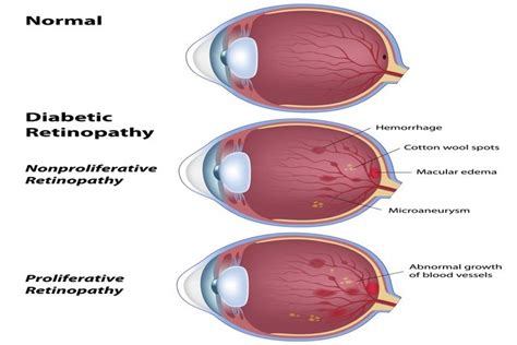 Symptoms Causes Types Risk Factors Diagnosis Stages Treatment