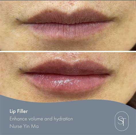 Lip Filler In Melbourne And Adelaide Lip Enhancement Melbourne Skintech