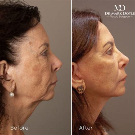 Frown Lines And Forehead Lines Prevention And Treatment