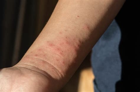 Top 10 Most Dangerous Bugs In The World