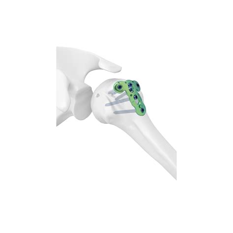 Proximal Humeral Greater Tuberosity Locking Compression Plate Oemandodm
