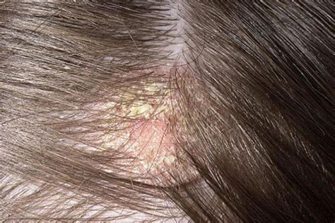 Себорейный дерматит причины симптомы фото лечение