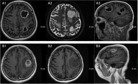 Brain Metastasis Cancer Care