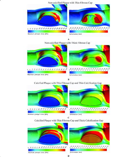 Fluid Structural Interaction Analysis Of Three Dimensional Plaque
