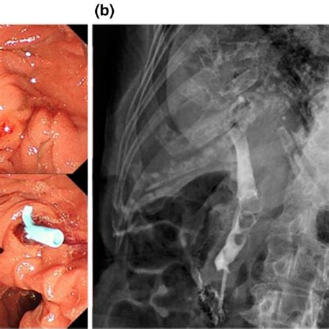 Bile Duct Stent Placement During Ercp For Acute Cholangitis A