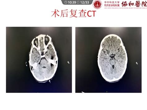 异物致儿童开放性颅脑损伤的诊治符三例报告 脑医汇