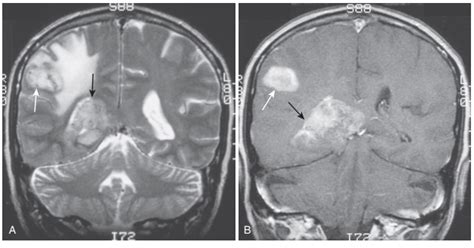 Olfactory Groove Meningioma Radiopaedia Mapasgmaes