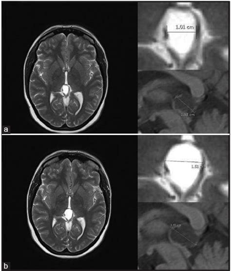 Surgical Neurology International