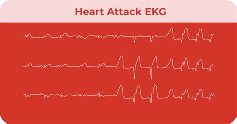 Normal Ecg Vs Heart Attack Ecg Ecg Basics Video Causes And Meaning
