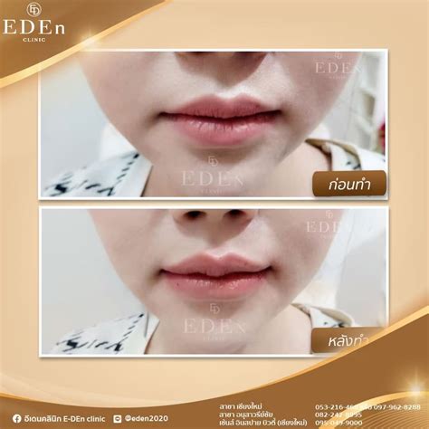 Lip Reconstruction เสริมหน้าอก เชียงใหม่ รีวิวเสริมหน้าอก ที่ไหนดี