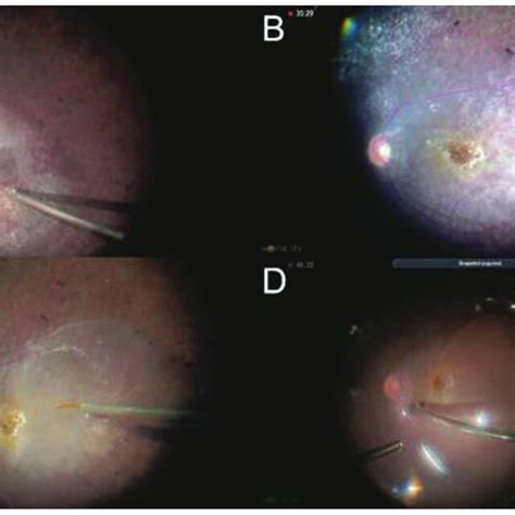 A Posterior Hyaloid Detachment B 41 Gauge Canula Penetration At
