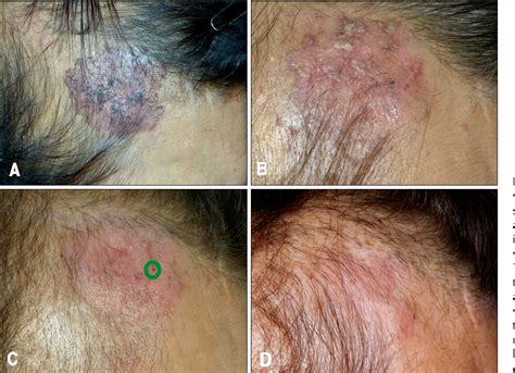 Superficial Basal Cell Carcinoma Early Stages