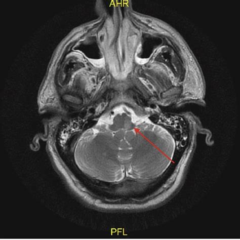 Mri Head Showing Left Medullary Infarction On Axial View Download Scientific Diagram