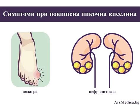 Симптоми при повишена пикочна киселина Arsmedica Bg