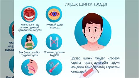 Улаанбурхан өвчний шинж тэмдэг Youtube