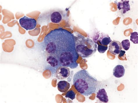 Multinucleated Plasma Cell Multiple Myeloma Stock Image Image Of