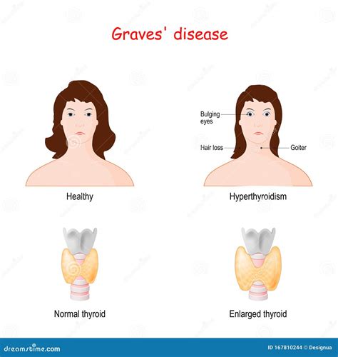 Goiter Cartoon Vector 53508017