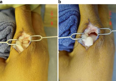 Locking Of The Index Finger Metacarpophalangeal Joint Due To A Chronic Osteochondral Fracture
