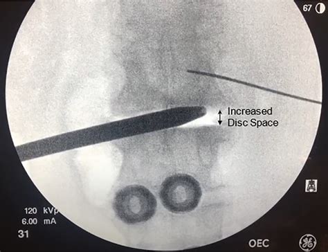 Anatomic Physiologic Indirect Decompression Anesthesia Key