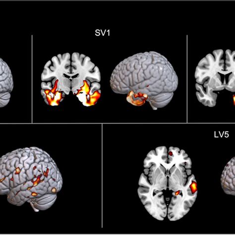 Results Of Whole Brain Voxel Based Morphometry Analysis Showing Atrophy Download Scientific