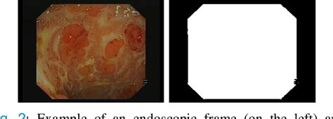 Figure 4 From Detection Of Ulcerative Colitis Lesions From Weakly Annotated Colonoscopy Videos