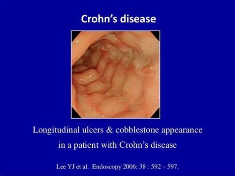 Tb Or Not Tb A Diagnostic Challenge
