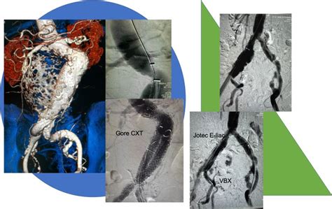 Emiliano Chisci On Linkedin Evar Without Iodinated Contrast Sometimes It Is Really Necessary