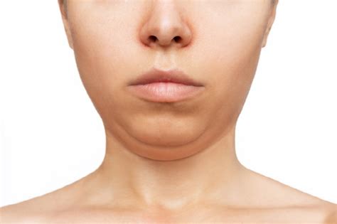 열심히 살 빼도 턱살 은 그대로 이유는