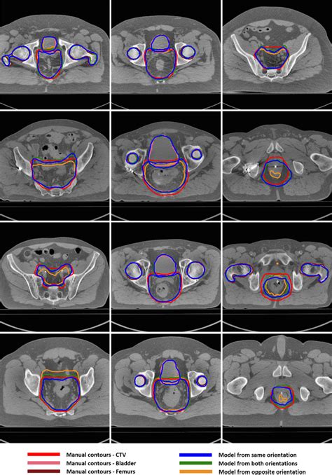 Segmentation Results On Cases Position In Supine Using Cnn Models Download Scientific Diagram