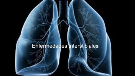 Enfermedades Intersticiales Dra Batista Udocz