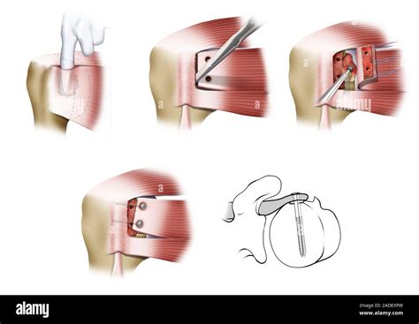Mclaughlin Procedure Shoulder Surgery Illustration This Operation Is Used To Treat Or Prevent
