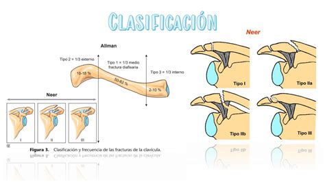 Clasificación De Fractura De Clavícula