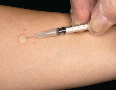 Intradermal Injection Test For Drug Sensitivity Rnpedia