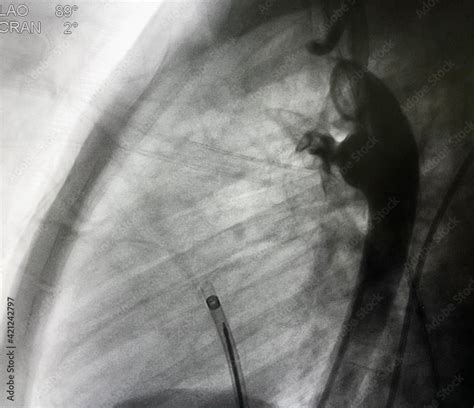 Aortography Showed Patent Ductus Arteriosus PDA During PDA Closure Device Via Endovascular