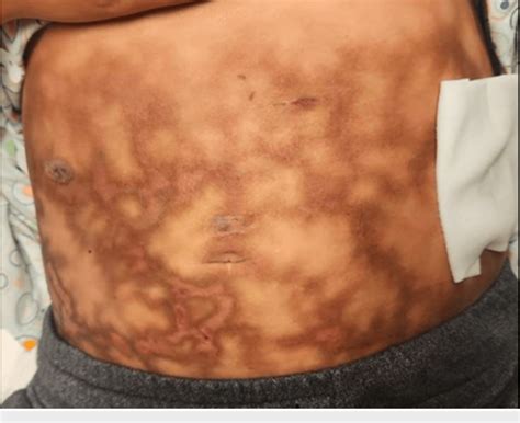 Figure 1 From Erythema Ab Igne Toasted Skin Syndrome As A Cutaneous