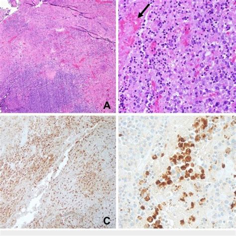 Excisional Lymph Node Biopsy A Extensive Necrosis Pink 40x B
