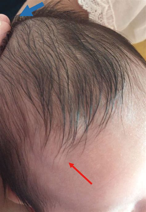 Hong Kong Journal Of Paediatrics [hk J Paediatr New Series 2021 26 99 102]